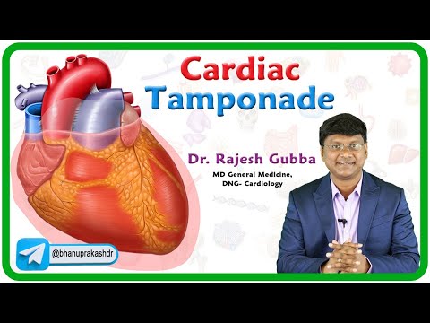 Cardiac Tamponade : Etiology, Pathophysiology, Clinical features, Diagnosis and Treatment