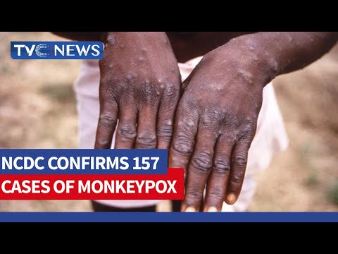 Breaking News: NCDC Confirms 157 Cases Of Monkeypox In Nigeria