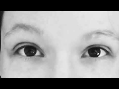 Sustained Eyelid Spasms when closing the eyes and looking up