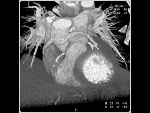 3 Venous Bypass Grafts CCTA