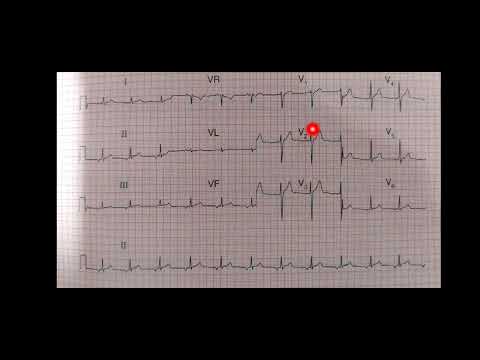 Ectopic atrial rhythm