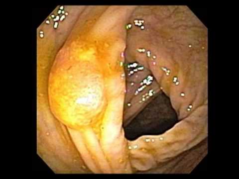 Polyposis Syndrome/Genetic GI: Endoscopic Diagnosis and Management (DV068) Video Clip
