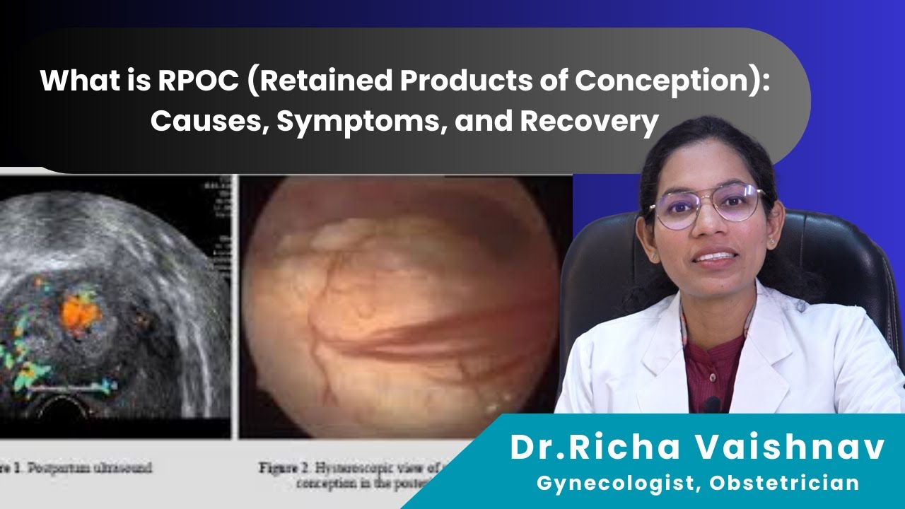 What is RPOC (Retained Products of Conception): Causes, Symptoms, and Recovery | Dr RIcha Vaishnav
