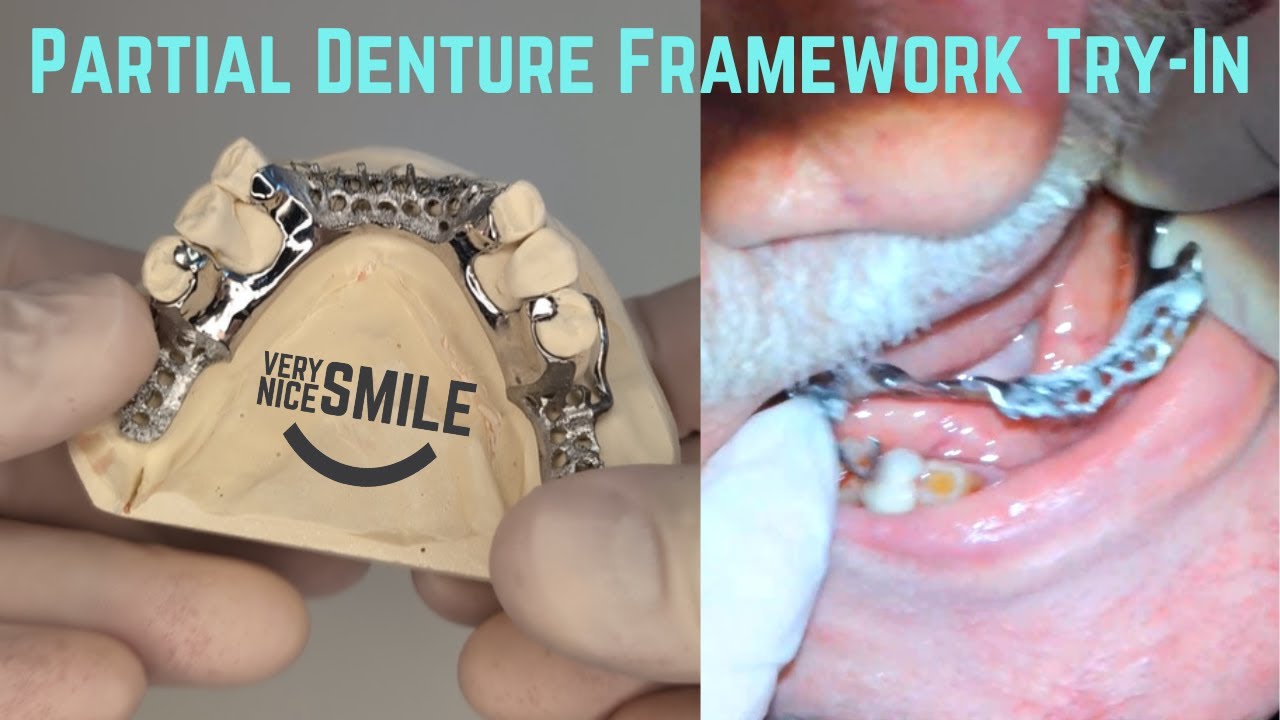 Partial denture with metal framework try in