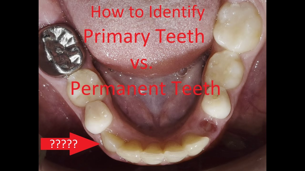 How to Identify Primary Teeth vs. Permanent Teeth