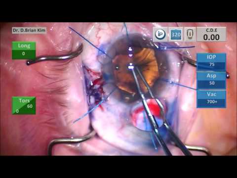 Trifecta: Brunescent Cataract, Tiny Pupil, Zonulopathy