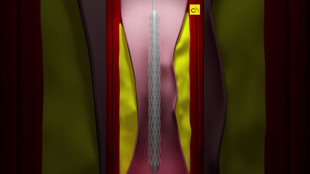 Angioplasty vs Bypass Surgery - Credihealth