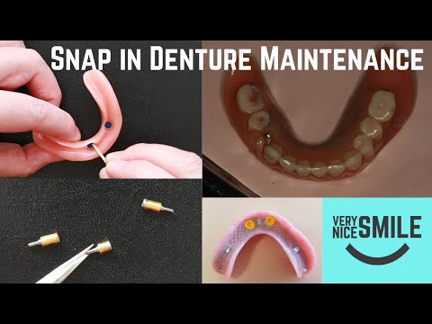 What goes wrong with snap in dentures.