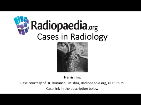 Harris ring (Radiopaedia.org) Cases in Radiology