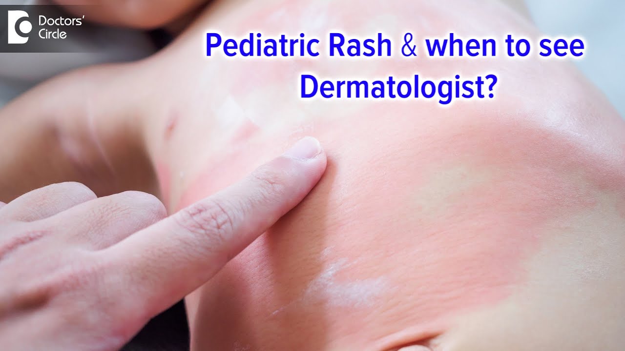 PEDIATRIC RASH | When to see a Dermatologist for PEDIATRIC RASH? -Dr. Divya Sharma | Doctors' Circle