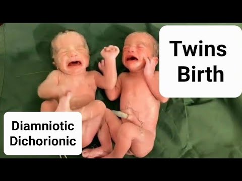 Twins Birth || Twin Babies || Dichorionic Diamniotic Breech Twins - Dr Tayyab Riaz Ch