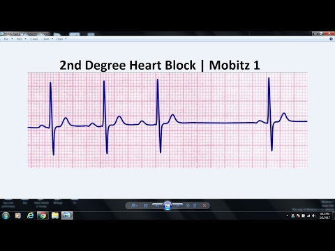 Second Degree Heart Block | Mobitz Type 1 Heart Block | Wenckebach Block