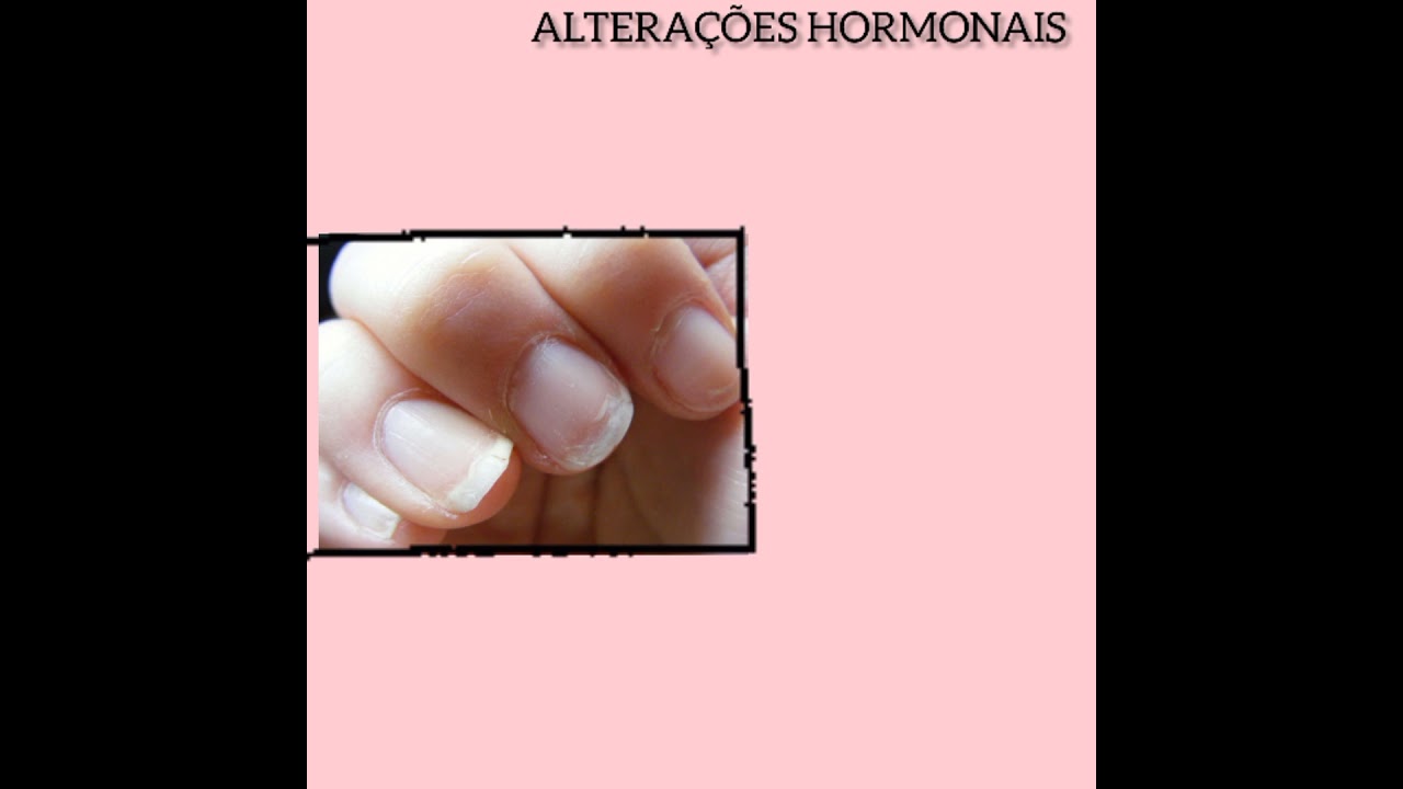 6 principais causas de unhas fracas