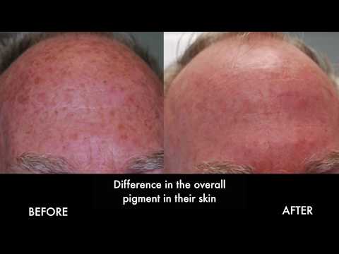 Best Treatment for Brown Spots | Tampa, FL