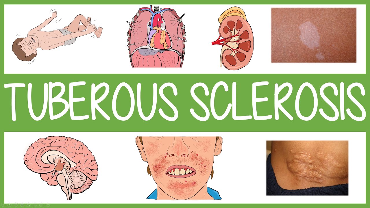 Tuberous Sclerosis Complex in 3 Minutes