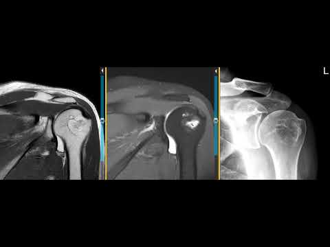 Intraosseus lipoma humeral head