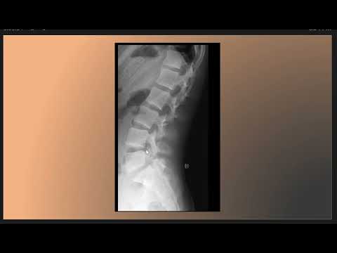 Short Case Discussion : Grade I anterolisthesis and spondylolisthesis.
