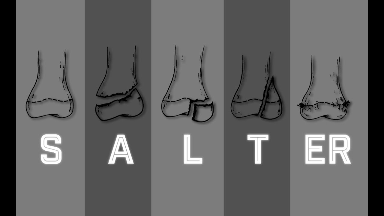 Salter Harris Fracture Classification - MEDZCOOL