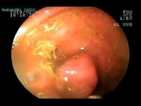 02022019 Colonoscopy for Terminal ileitis suspection