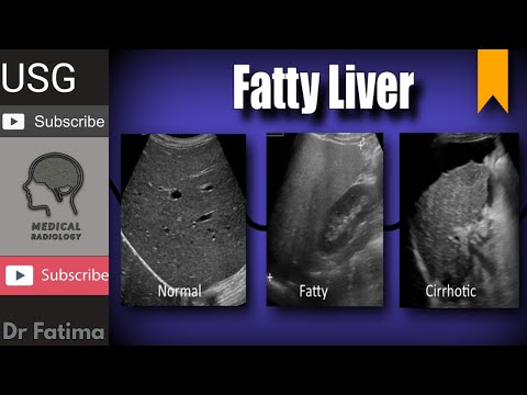 Liver normal echogenicity & fatty liver with texture complete ultrasound lecture by Dr.Fatima
