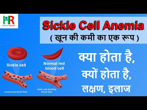 Sickle Cell Anemia | Sickle Cell Anemia in hindi | sickle cell anemia treatment in hindi | cause