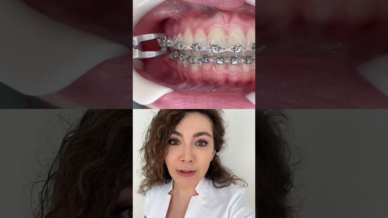How Do Dentists Remove Braces?!