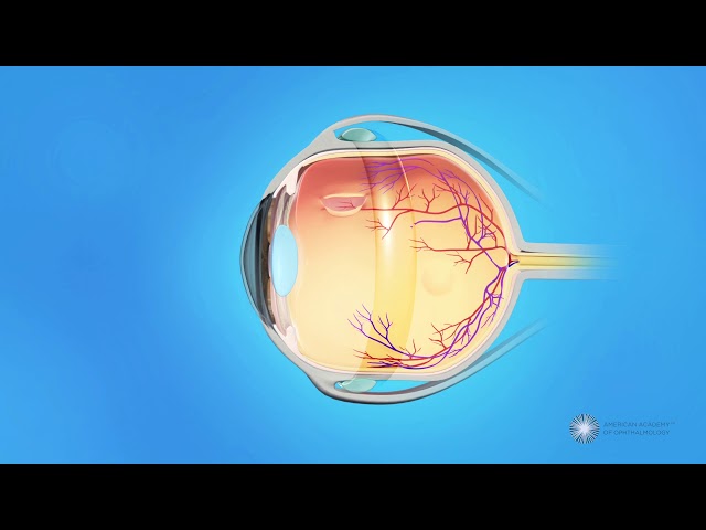 Retinal Implants - a&n Silicone Retinal Implant Trader - Wholesaler ...