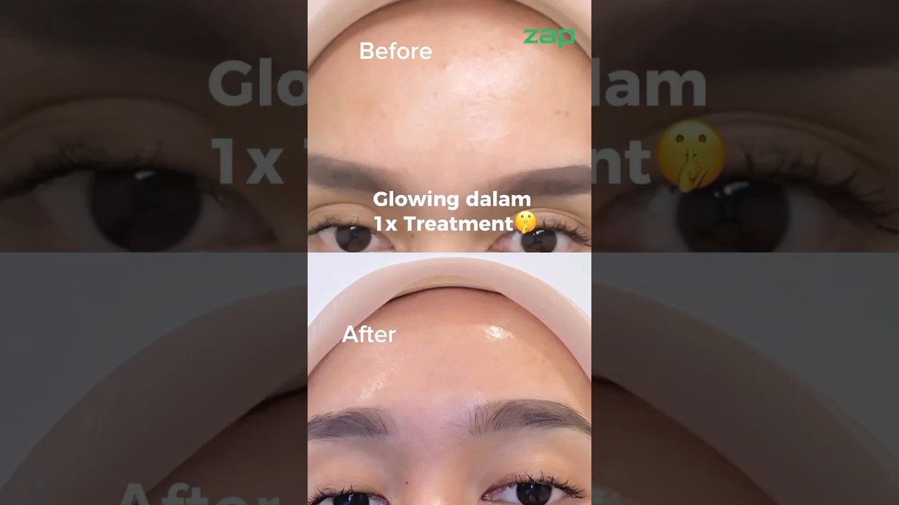 Wajah Glowing Dalam 1x Treatment, Coba Insta Glow Serum Micro Injection Hanya Di ZAP🥰