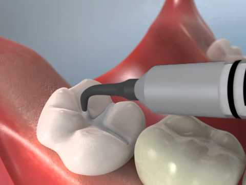 Sealants