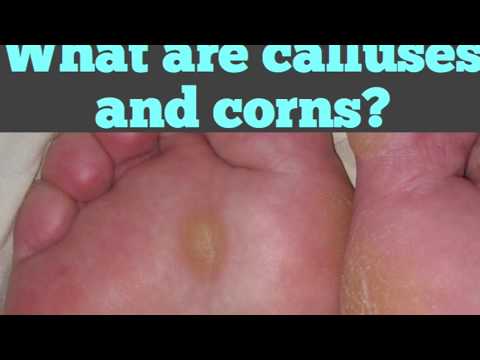 What are corns and calluses?