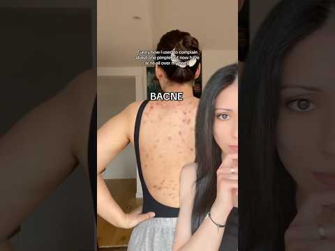 SCHIENA e BRUFOLI: i miei sconsigli ✅