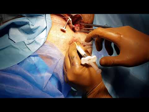 Nüks anal fistülde ''Permacol Paste '' uygulaması. Op: Prof. Dr. Cem Terzi