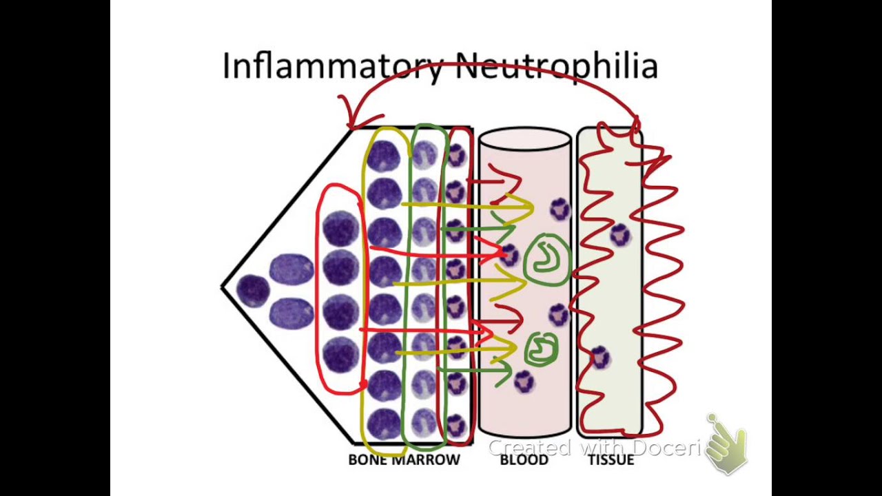 Inflammatory Neutrophilia
