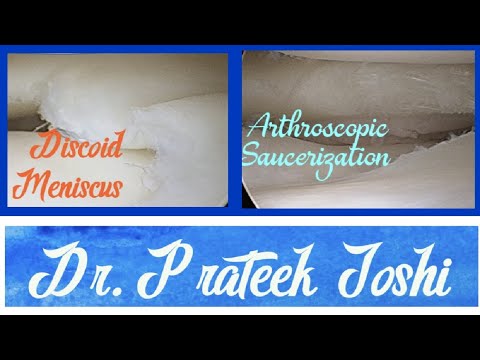 Arthroscopic Saucerization Partial Meniscectomy | Discoid Lateral Meniscus | Dr. Prateek Joshi