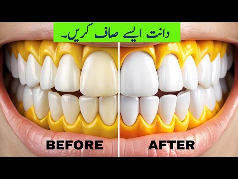 Teeth Whitening at Home | Dant Saaf Karne Ka Tarika