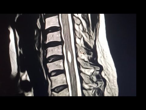 syrinx in cervical spine