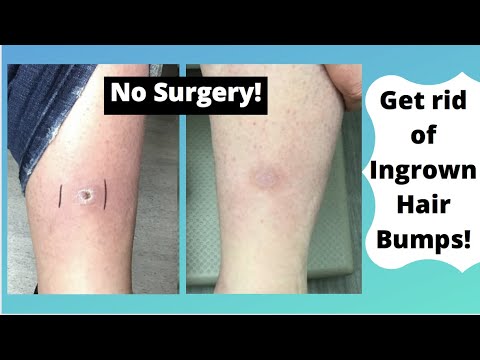 Dermatofibromas Removal – Get rid of hard scars!