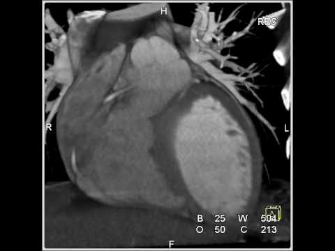Cardiac: Right Coronary Artery (7 of 7)