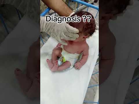 Down Syndrome Baby in NICU | Oxygen Free Trial #baby #neonatologist #neonatalicu #nicu #niculife