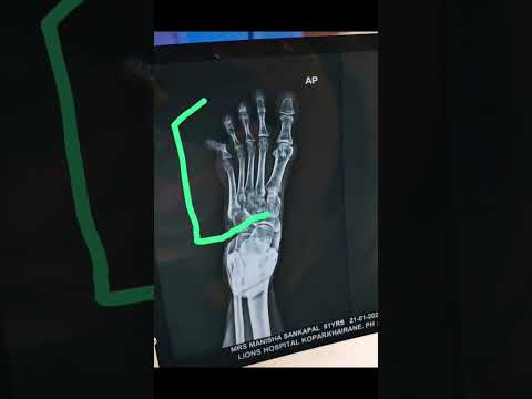 Guess Xray # 5 th proximal phalanx fracture # Anatomy#viral #shorts #medicos #doctor 👀👀