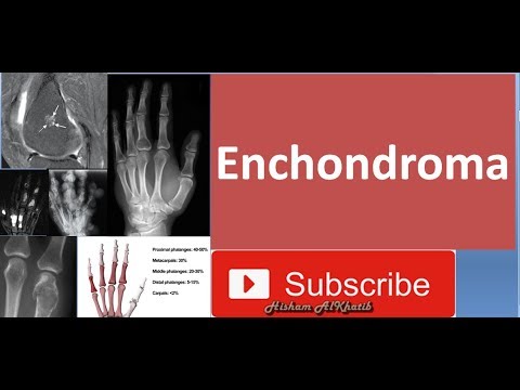 Enchondroma
