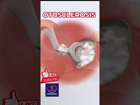 Otosclerosis | Ear Condition