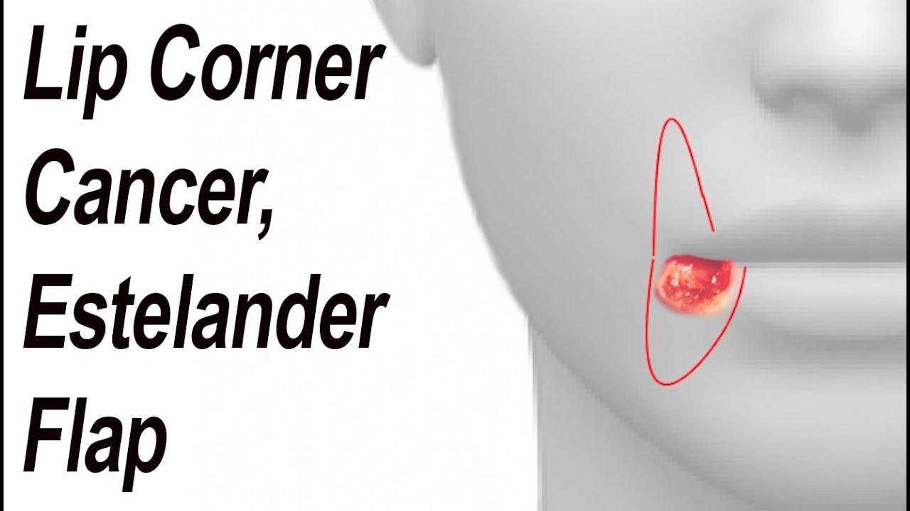 Lip Corner Cancer Excision with Estelander Flap Reconstruction