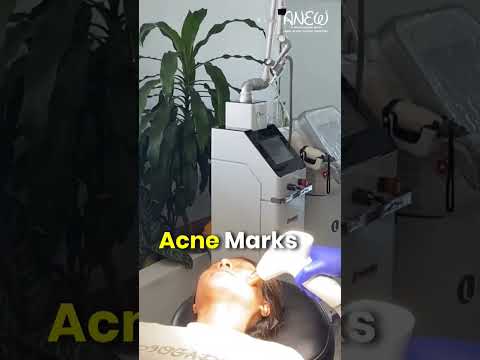 Skin Resurfacing | Anew Cosmetic Clinic
