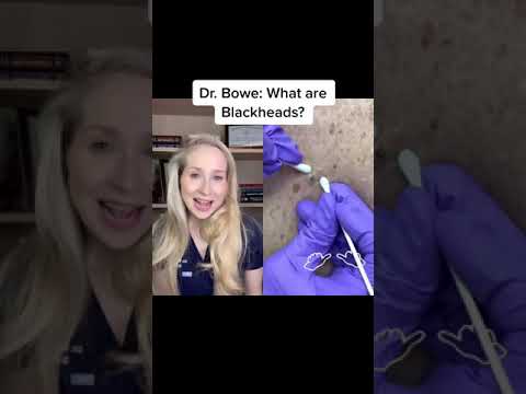 What are blackheads? #Shorts