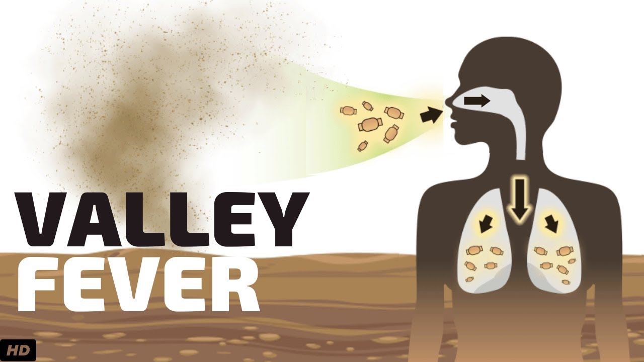 Valley Fever, Causes, Signs and Symptoms, Diagnosis and Treatment.