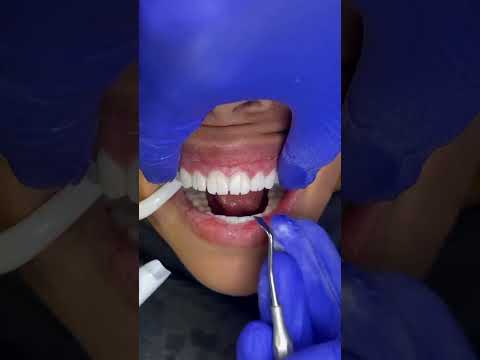 Breaking away temporary smile on revision case #dentist #dentistry #veneers