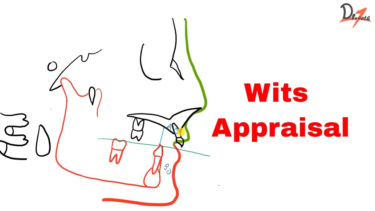 Wits Appraisal | Cephalometrics |