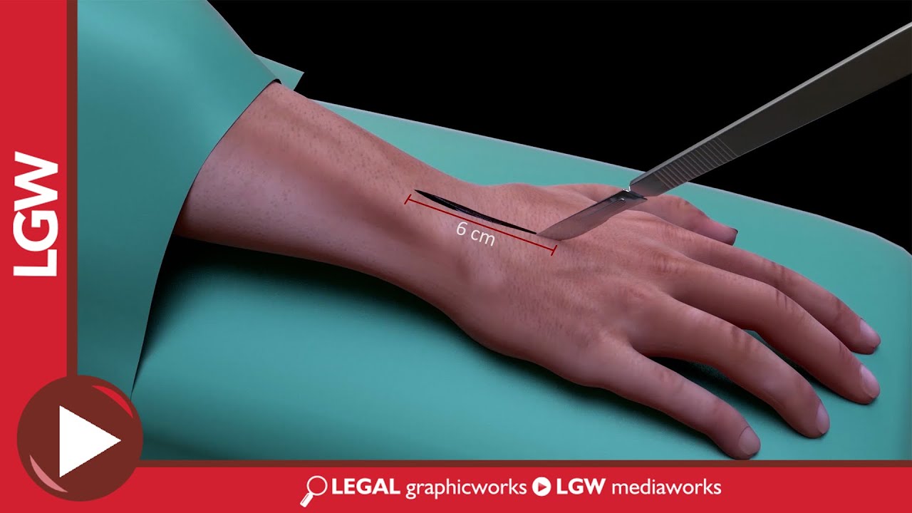 Right Ring Finger Trigger Release 3D Animation