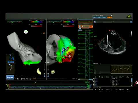 23 English Live Case CIEDs, CRT D – Miguel Valderrabano
